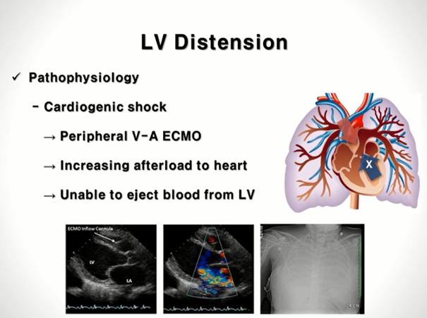 ECMO 기본이론_ ECMO mode 소개, 삽입 전후 간호, 모니터링, 합병증, weaning : 네이버 블로그