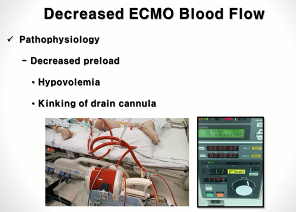 ECMO 기본이론_ ECMO mode 소개, 삽입 전후 간호, 모니터링, 합병증, weaning : 네이버 블로그