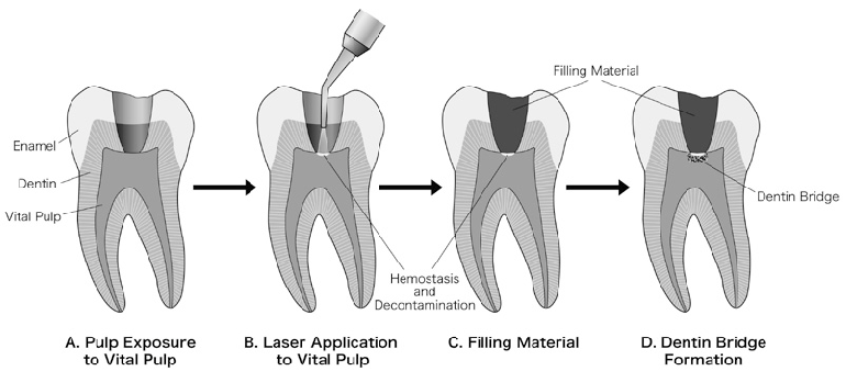 신경치료 피하는 법 (direct pulp capping) : 네이버 블로그