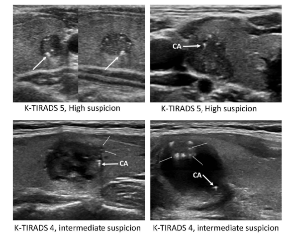 갑상선 결절 진단과 치료 update (2021 K-TIRADS) : 네이버 블로그