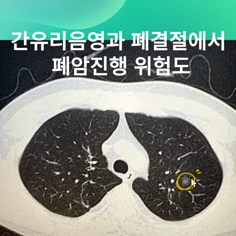 간유리음영과 폐결절에서 폐암진행 위험도 Feat홍혜걸 투병고백 네이버 블로그