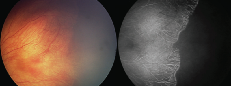 [EYE잘보여] 가족삼출유리체망막병증(Familial Exudative VitreoRetinopathy; FEVR) : 네이버 블로그