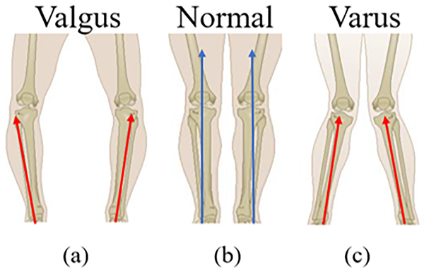 정형외과 :: HTO _ High Tibial Osteotomy _ 근위경골절골술 : 네이버 블로그