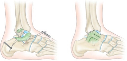 정형외과 :: MBO _ Modified Brostrom Operation (발목 인대 고정술) : 네이버 블로그