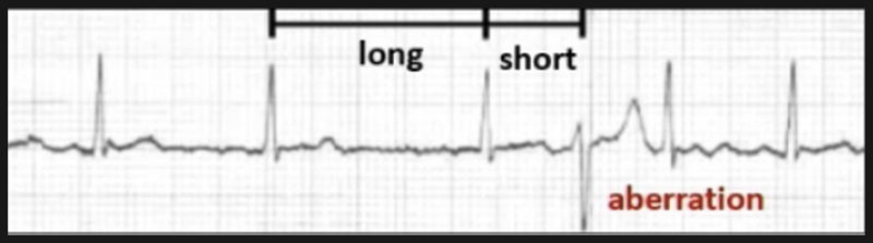 aberrant conduction (편위 전도) : 네이버 블로그