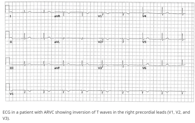 [ECG] Arrhythmogenic right ventricular cardiomyopathy (ARVC) : ① ...