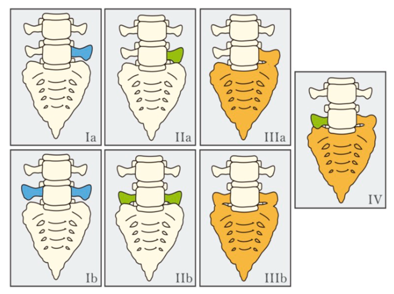 허리뼈가 6개라는데 괜찮나요? (천추의 요추화, 이행성 척추란...) : 네이버 블로그