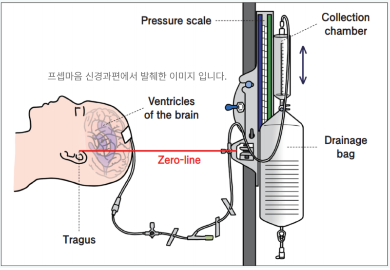 의학용어 EVD 정의, 간호 총정리! : 네이버 블로그
