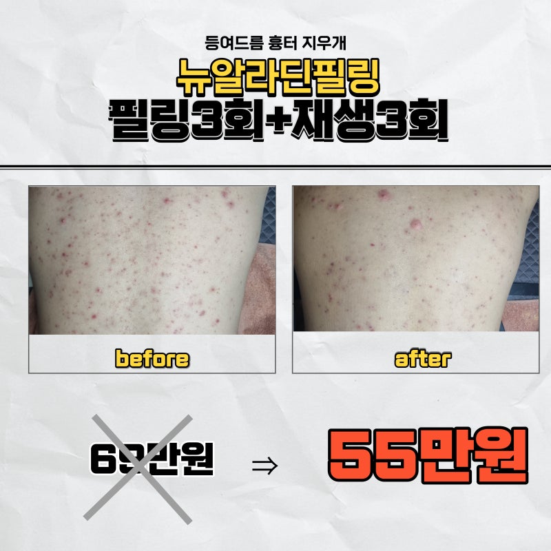 강릉 피부관리 등드름등흉터뉴알라딘필링패키지 네이버 블로그
