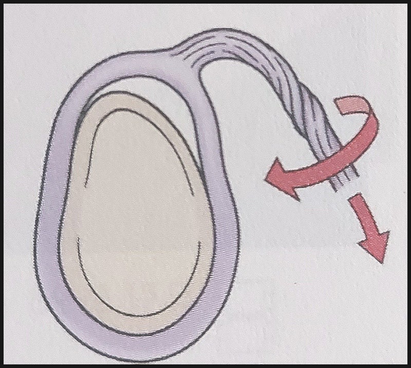슬랩 병변(SLAP lesion) : 원인과 검사 방법 - O'brien / Kibler / Clunk / Crank test ...