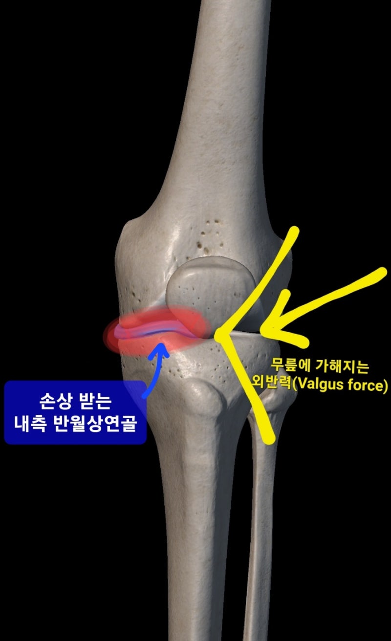 외측 / 내측 반월상연골 (반달연골, Meniscus) 파열 검사 : 아플레이 압박 검사(Apley's Compression ...