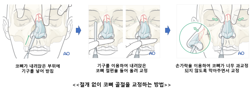 코 코뼈 골절비골 골절 Nasal Bone Fracture 네이버 블로그