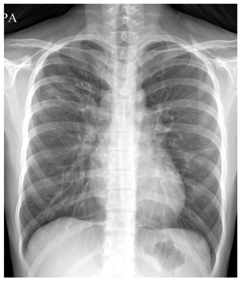활동성 폐결핵 폐엑스레이 X Ray 증례 증상 특징 소견 폐결절 Ct 소견 네이버 블로그