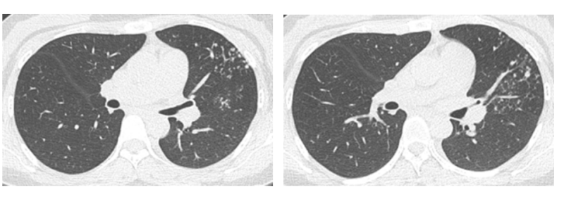 활동성 폐결핵 폐엑스레이 X Ray 증례 증상 특징 소견 폐결절 Ct 소견 네이버 블로그