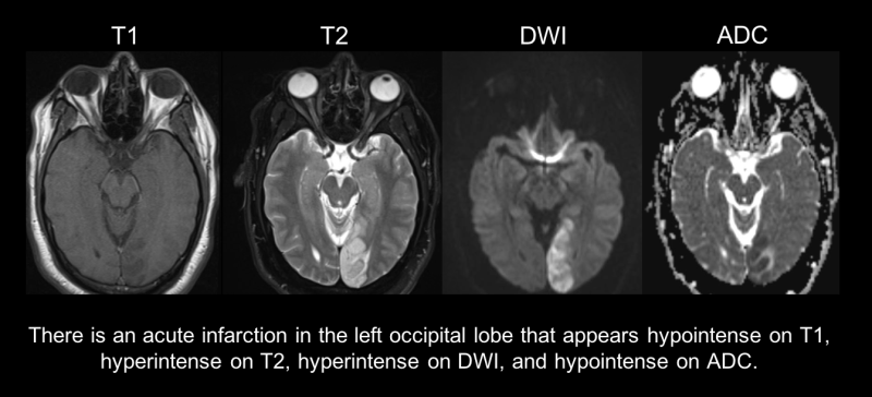brain MRI 기초 - 기본 원리 그리고 T1, T2, Flair, DWI, ADC의 특징 간단 정리 : 네이버 블로그