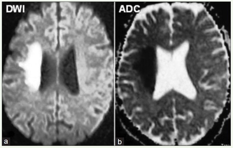 DWI에서 나타나는 T2 shine-through effect 그리고 ADC - brain MRI 영상 이해하기 : 네이버 블로그