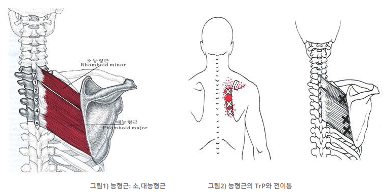 등통증 날개뼈 안쪽 통증 Feat 고황통 의 원인과 치료방법은 본앤장한의원 네이버 블로그