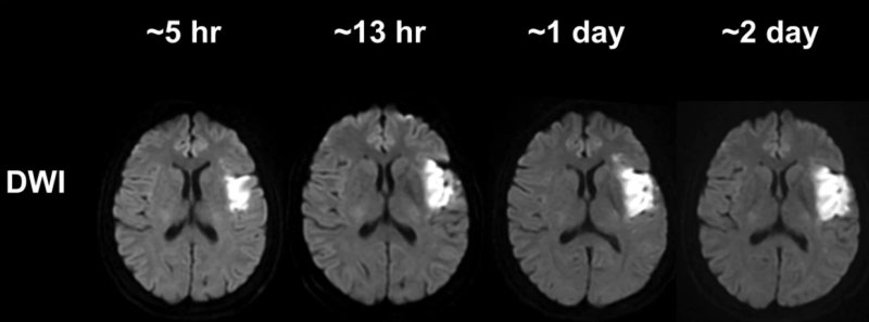 brain MRI 기초 - 기본 원리 그리고 T1, T2, Flair, DWI, ADC의 특징 간단 정리 : 네이버 블로그