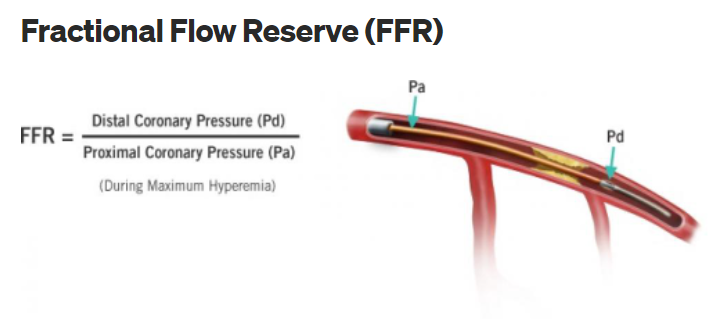 분획혈류예비력 (Fractional Flow Reserve, FFR) : 네이버 블로그