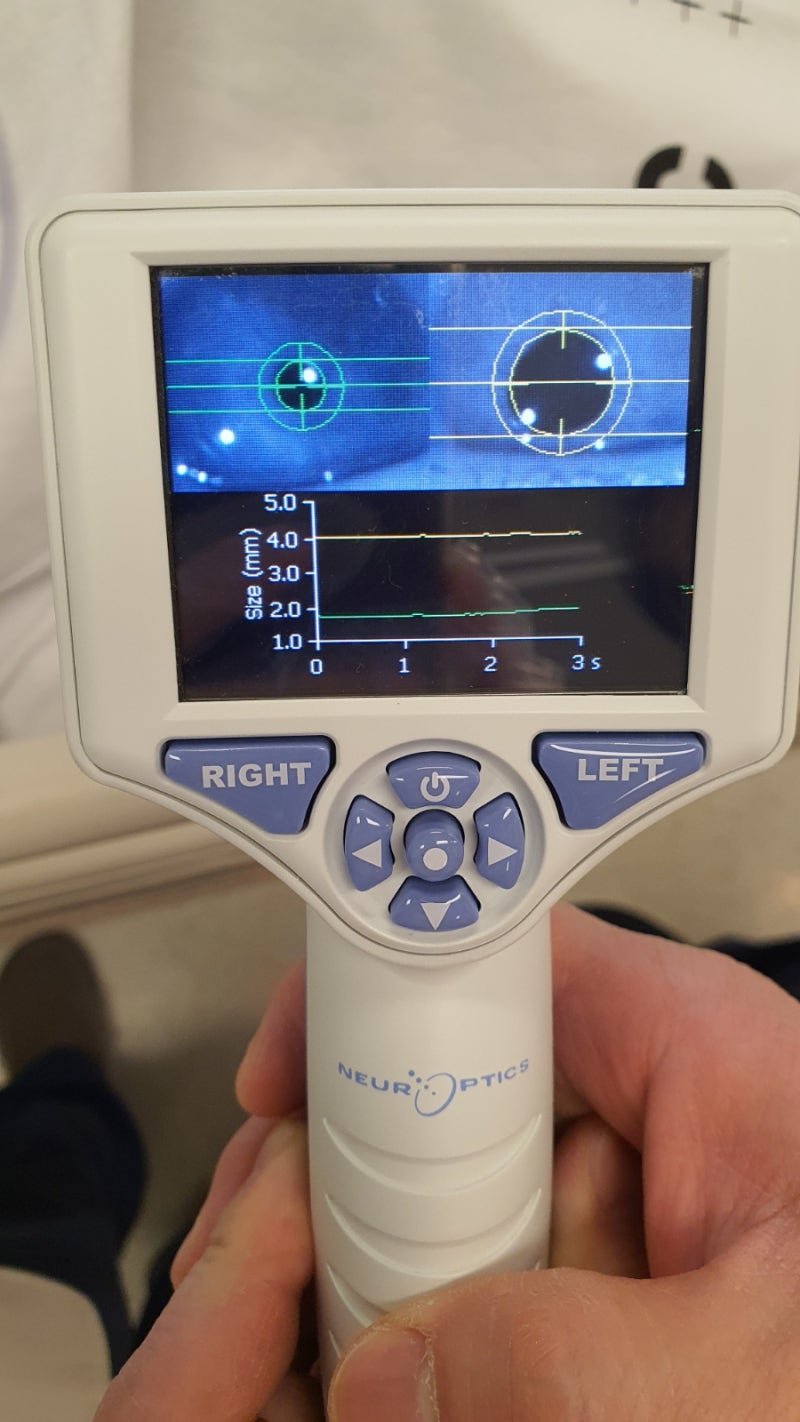 Pupilometer를 사용한 pupil size 측정 및 light reflex 평가하기 : 네이버 블로그