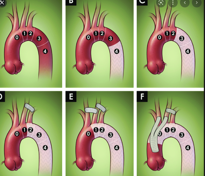 EVAR, TEVAR에 관해서 : 네이버 블로그