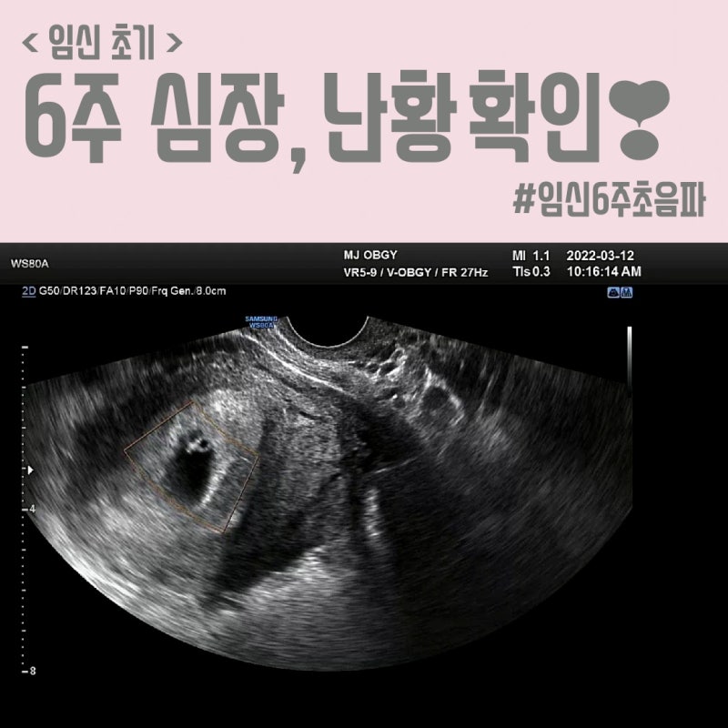 임신 초기 임신 6주 초음파 임신 6주 심장소리 난황 아기크기 임산부 코로나 고열 타이레놀 임신초기증상 착상혈