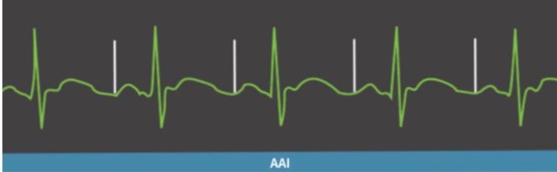 인공심박동기 - pacemaker 편(영구형 심박동기 Permanent pacemaekr & wire less PPM(micra ...