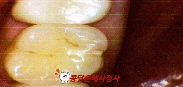 치아 파절 골절 부러짐 보상 방법식당에서 식사중 사고 네이버 블로그