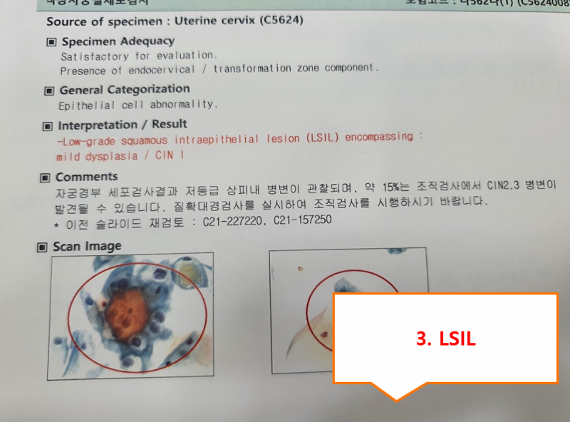 HSIL LSIL ASCUS ASC-H 단계별 진단과 치료의 차이점 : 네이버 블로그