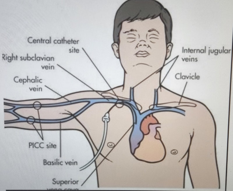중심정맥관의 모든 것 [C-line, PICC, HD cath, perm cath, IJC, AVF, AVG] : 네이버 블로그