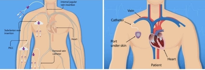 중심정맥관의 모든 것 [C-line, PICC, HD cath, perm cath, IJC, AVF, AVG] : 네이버 블로그