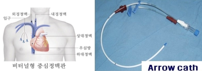 중심정맥관의 모든 것 [C-line, PICC, HD cath, perm cath, IJC, AVF, AVG] : 네이버 블로그
