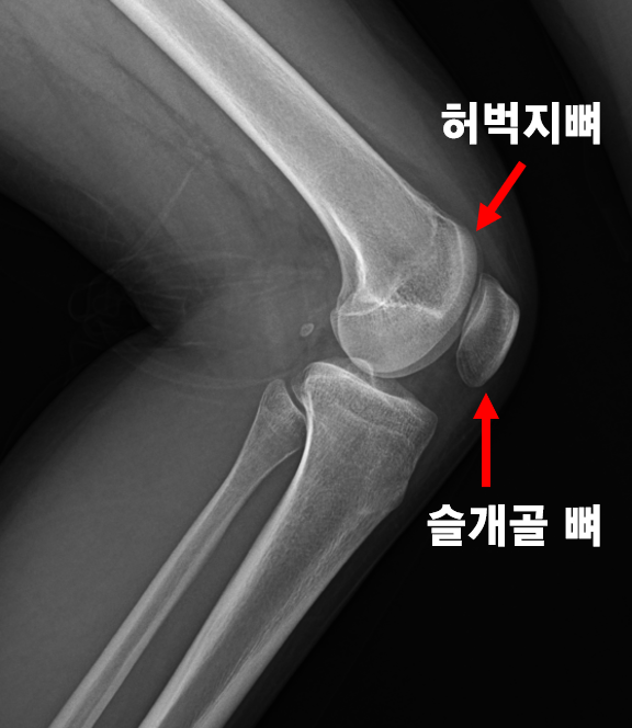 무릎 연골연화증 치료 방법 3가지 Ft 통증에 좋은 대퇴사두근 운동 네이버 블로그