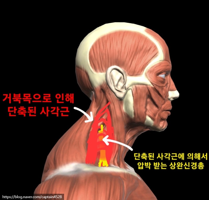 사각근 증후군scalene Syndrome 원인 증상 검사 애드손 검사 할스테드 검사 네이버 블로그