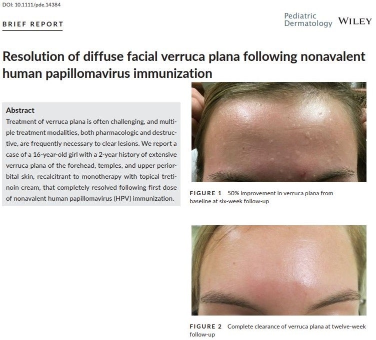 '편평사마귀'가 뭐야?(Plane Warts,HPV,원인,예방,치료,제거방법,주의사항,부작용,면역력?가다실?) : 네이버 블로그