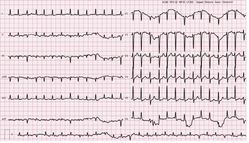 심전도, Electrical alternans [pericardial effusion] : 네이버 블로그