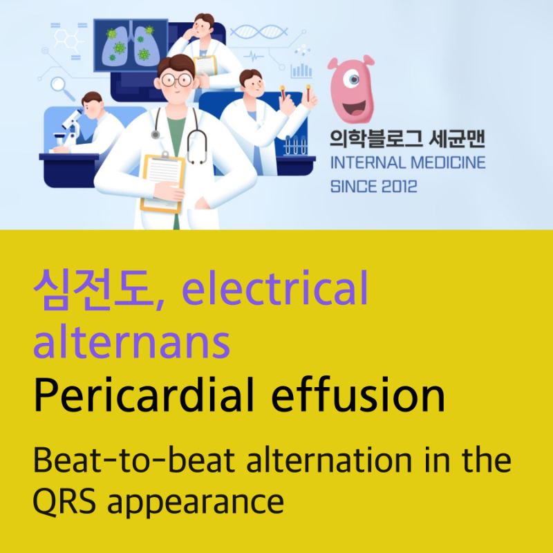 심전도, Electrical alternans [pericardial effusion] : 네이버 블로그