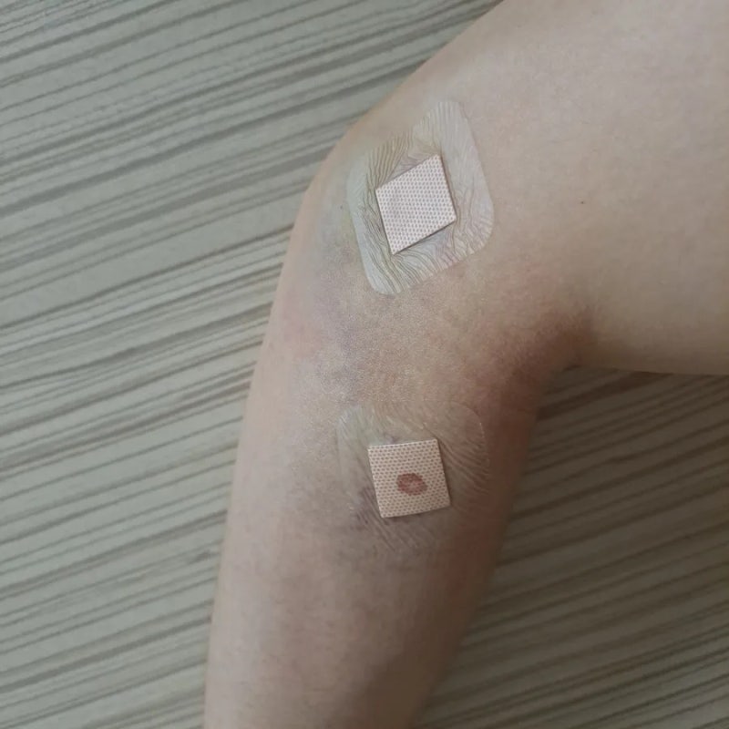 테니스 엘보 완치 후기치료방법 및 후유증 네이버 블로그