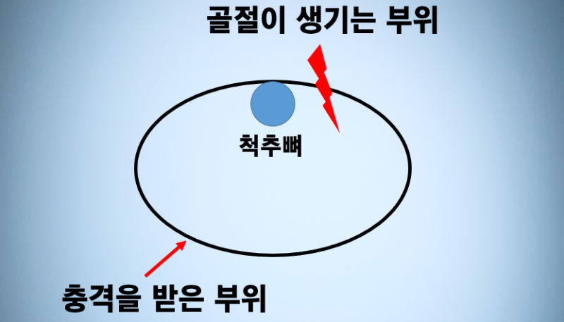 왼쪽갈비뼈통증 골프하고 생겼을때 치료방법 Ft골절 네이버 블로그