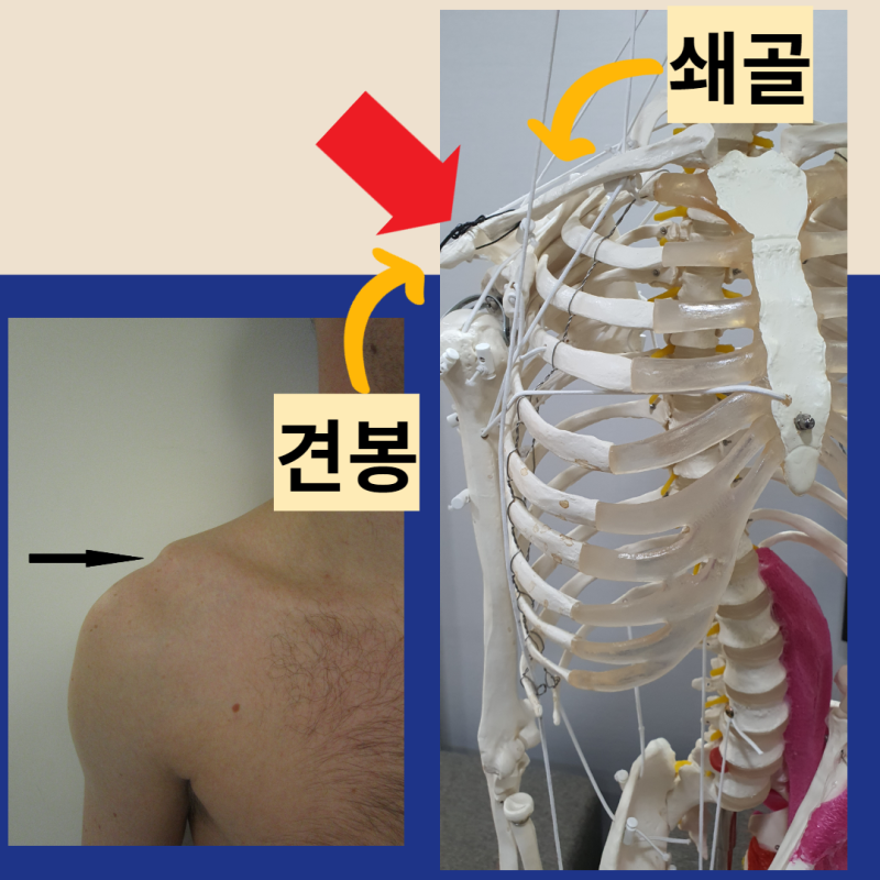 특이한 어깨통증 견봉쇄골관절 견쇄관절의 염증 돌출 및 통증이 있는 분 네이버 블로그
