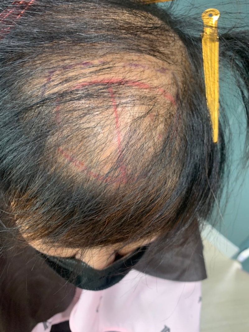 광주 두피관리 탈모치료 두피가 건강해지는 샴푸 방법 네이버 블로그