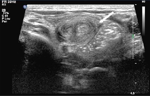 OHVIRA 증후군- 신생아 및 청소년에서 나타난 HHW 증후군의 두가지 사례 : 네이버 블로그