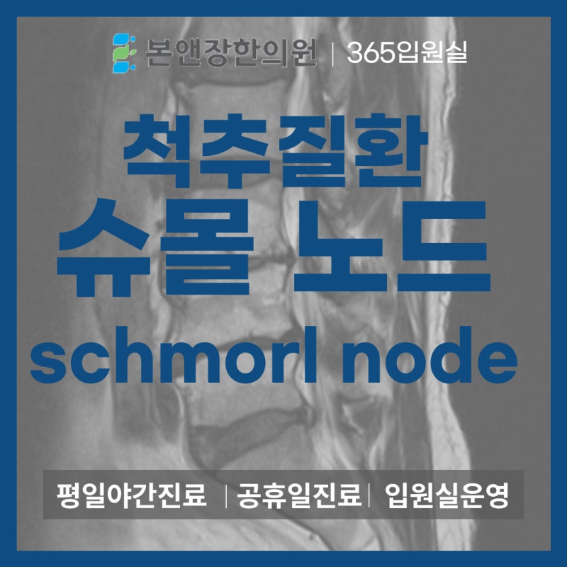 뼈로 디스크가 들어갔다? 슈몰결절(schmorl node)이란? : 네이버 블로그
