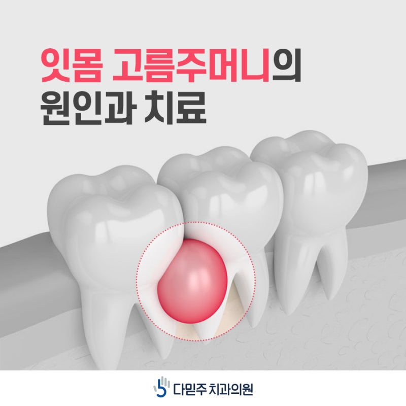 잇몸 잇몸 고름주머니의 원인 통증은치주농양 네이버 블로그