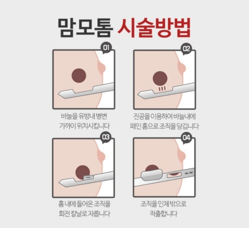 유방암 초음파 섬유선종 맘모톰 수술후기 삼성화재 실비청구 방법 네이버 블로그