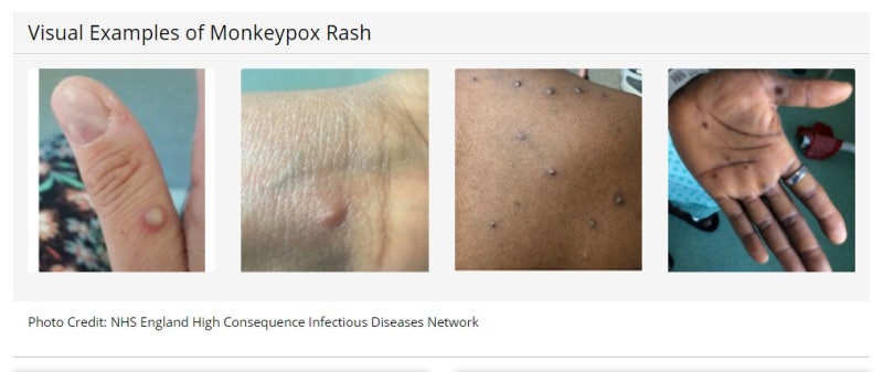 원숭이두창(Monkeypox)과 티폭스(Tpoxx: 테코비리마트 성분) : 네이버 블로그