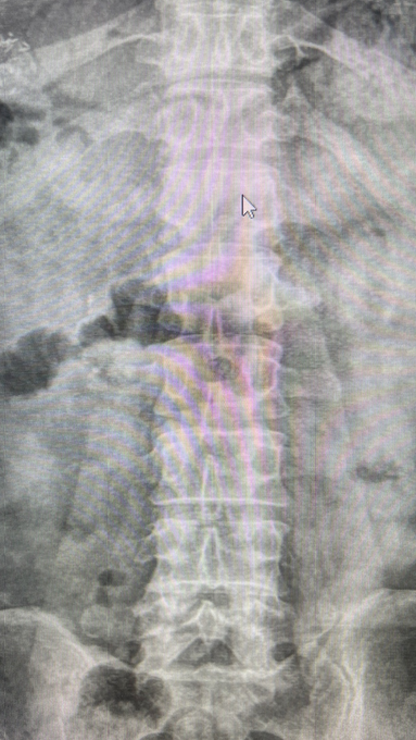 [요추] lumbosacral transitional vertebrae, Sacralization, Lumbarization ...