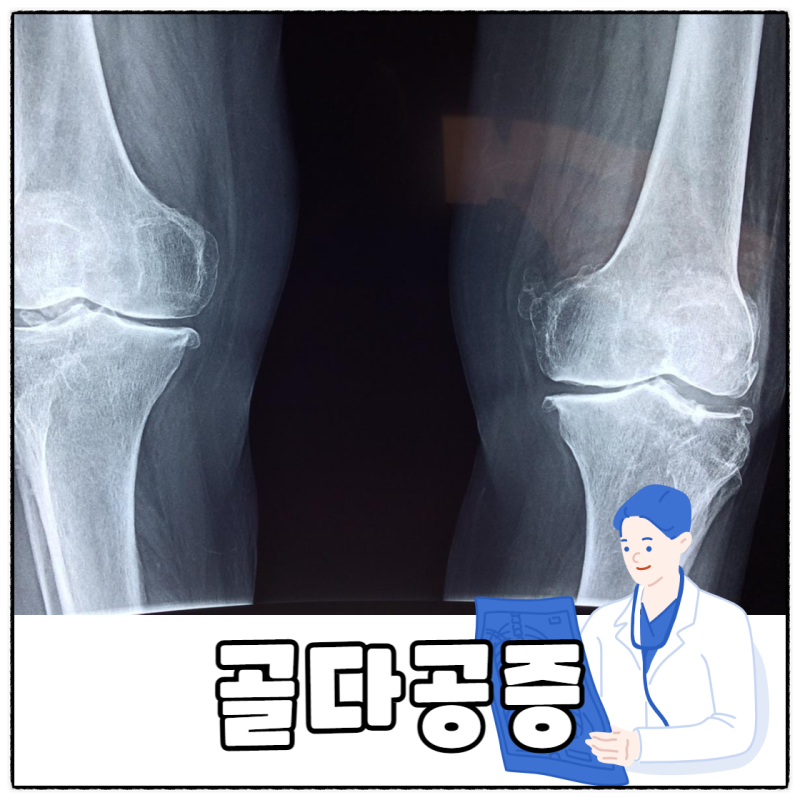 골밀도 정상수치 검사방법 골다공증 원인과 검사 네이버 블로그