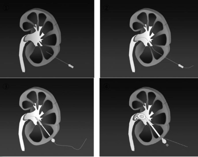 경피적 신루술(PCN,percutaneous nephrostomy) : 네이버 블로그