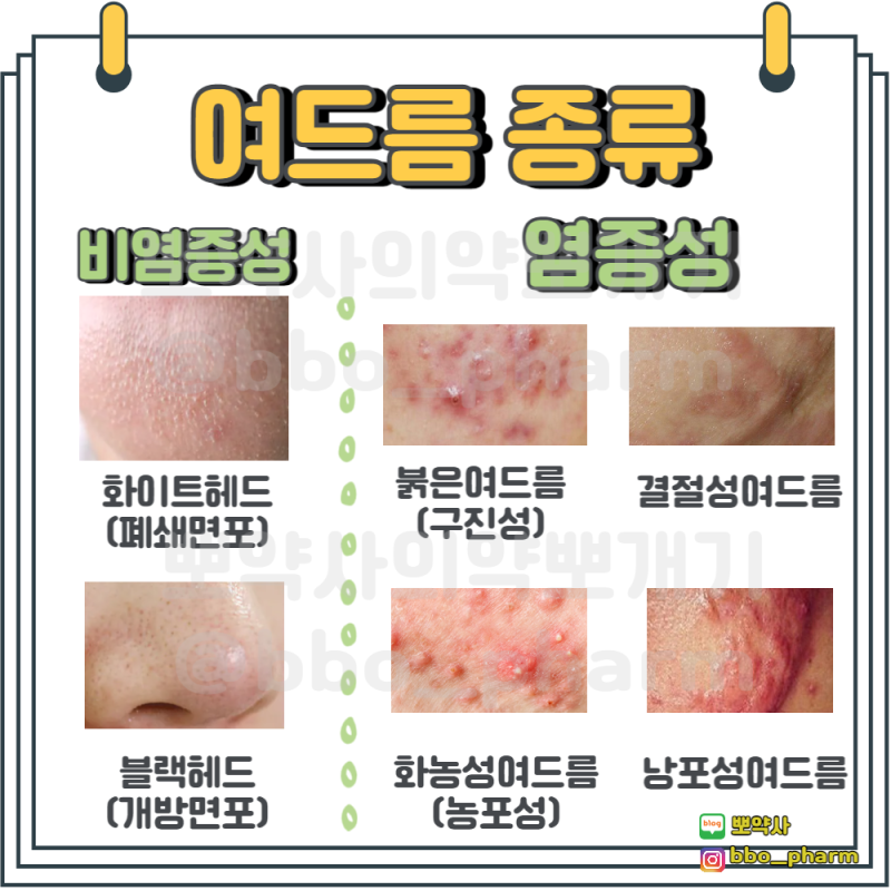 약국 여드름 약 추천 여드름에 맞게 고르는 방법 네이버 블로그